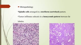 dermatofibrosarcoma protuberans histopathology | PPTX