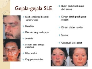 Systemic Lupus Erythematosus (SLE) | PPT