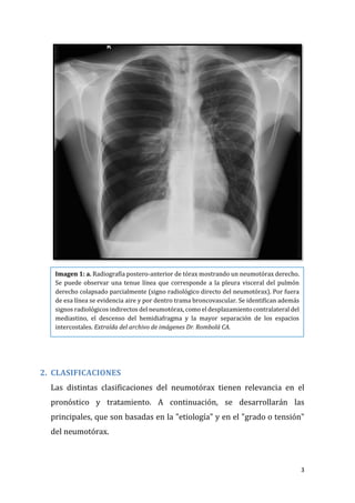 E2c. El neumotorax y los drenajes pleurales | PDF