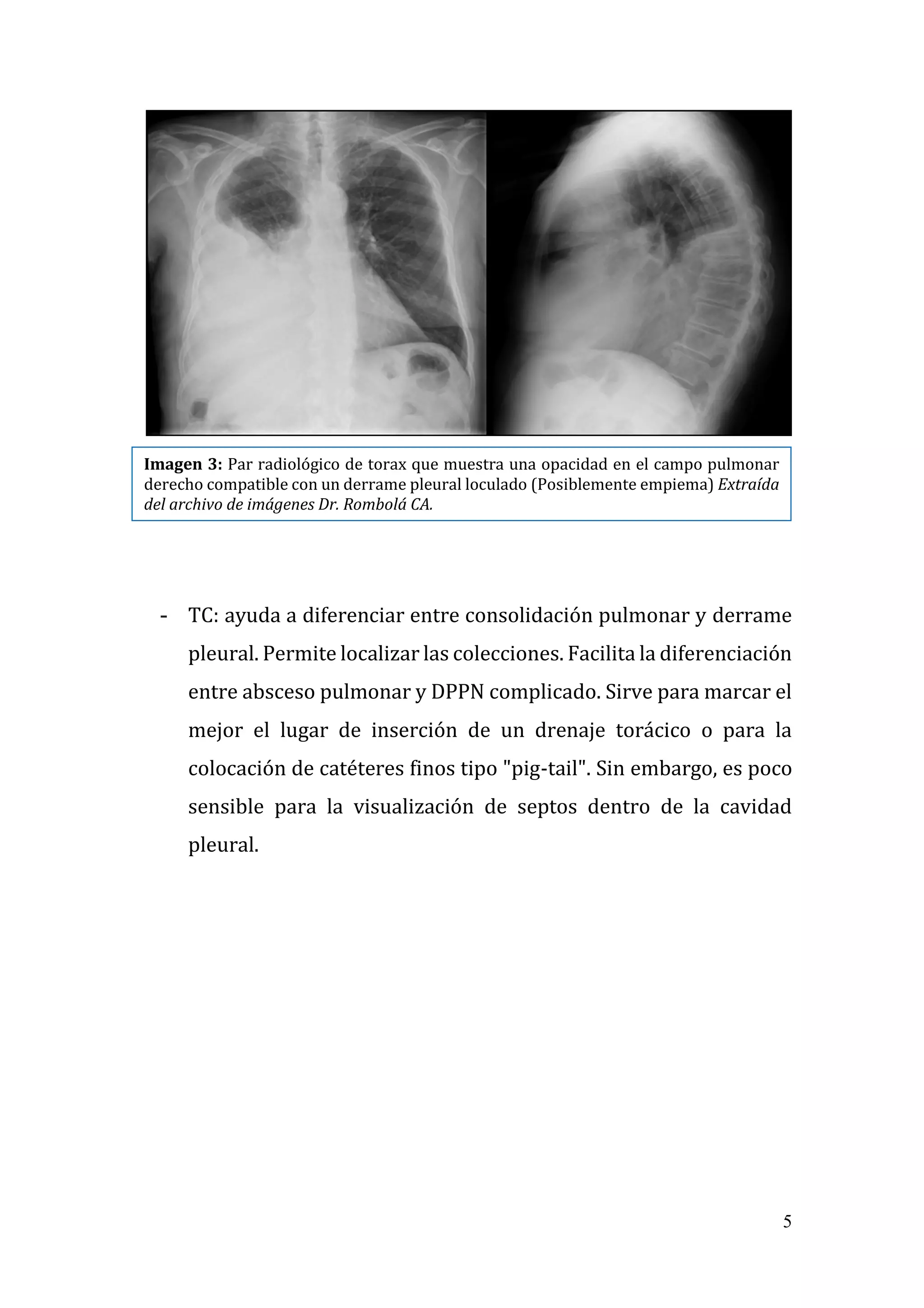 E2e. El empiema pleural y los drenajes | PDF