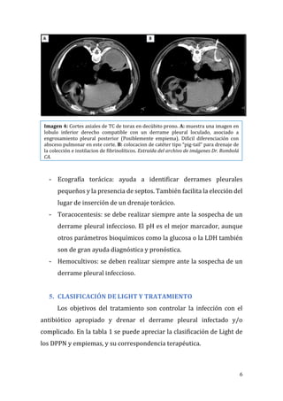 E2e. El empiema pleural y los drenajes | PDF