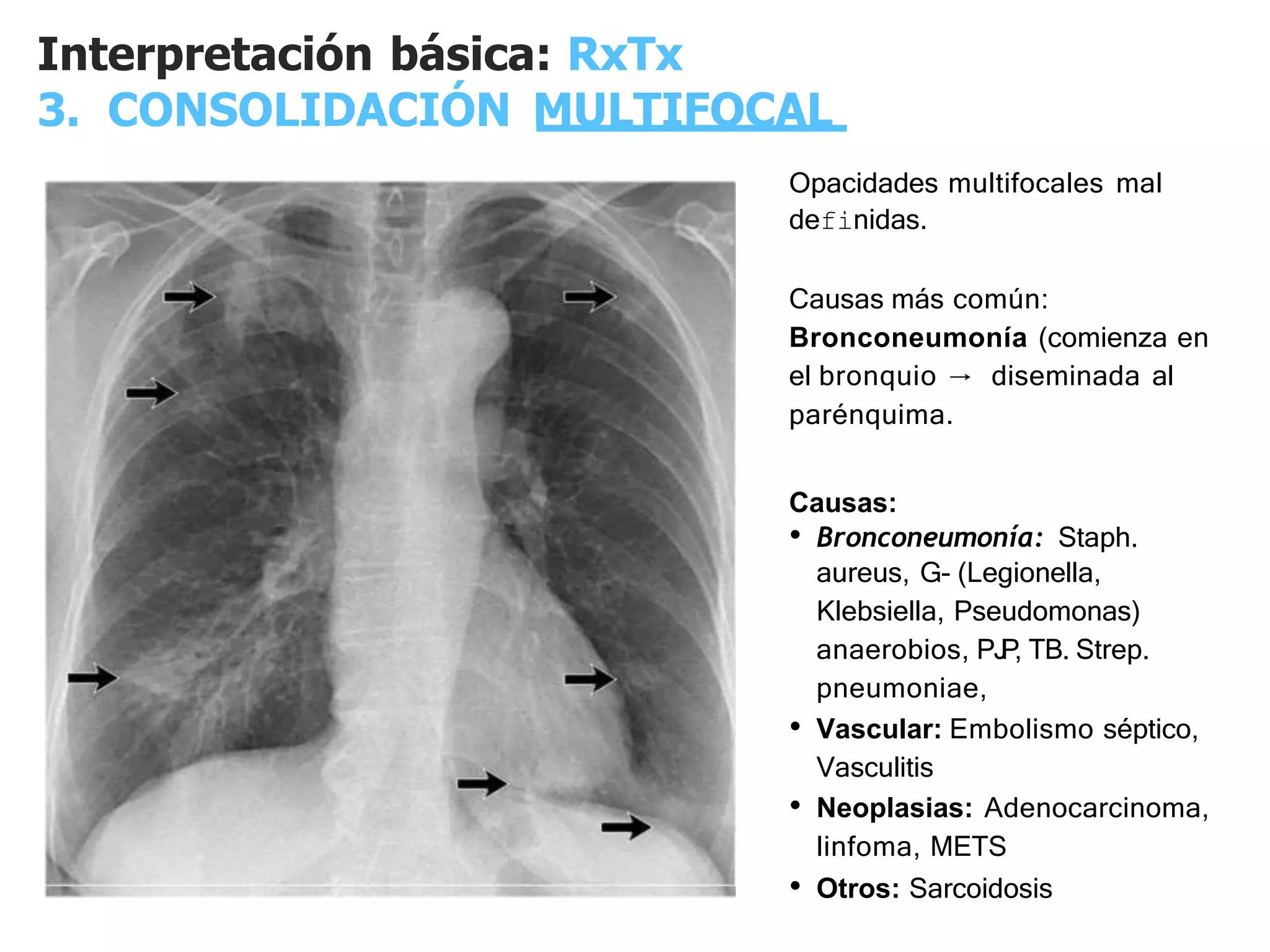 Rrx de torax interpretación y ej. de patologías, Clase de unam | PPTX
