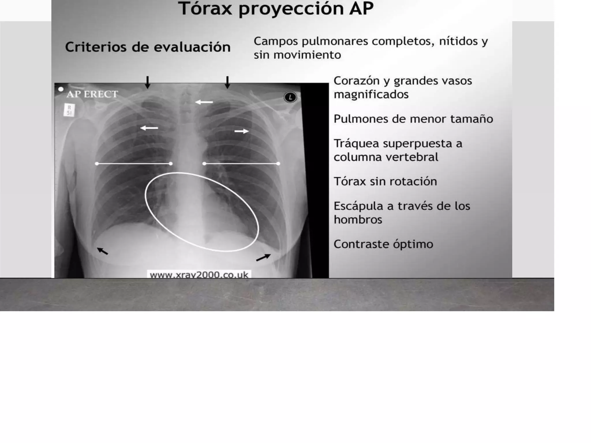 Rrx de torax interpretación y ej. de patologías, Clase de unam | PPTX