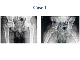 Short term outcomes of Intertrochanteric Imhauser Osteotomy combined ...