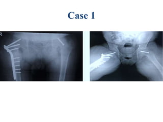 Short term outcomes of Intertrochanteric Imhauser Osteotomy combined ...