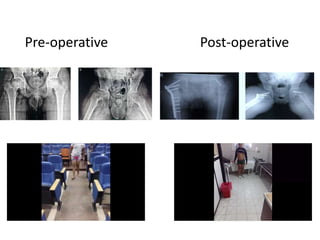 Short term outcomes of Intertrochanteric Imhauser Osteotomy combined ...