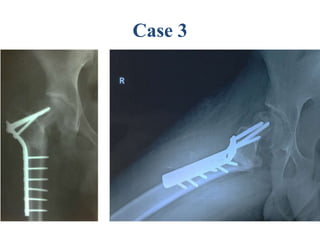 Short term outcomes of Intertrochanteric Imhauser Osteotomy combined ...