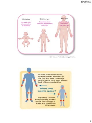 Moisturizers An Essential Component in Eczema Management | PDF