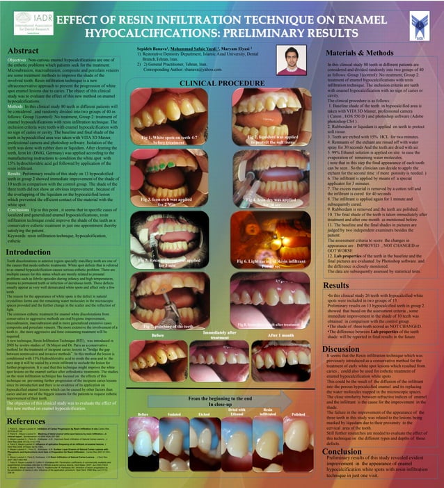 Resin Infiltration Poster English | PDF