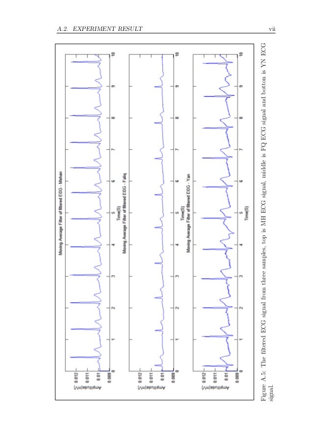 Analysis And Classification Of Ecg Signal Using Neural Network