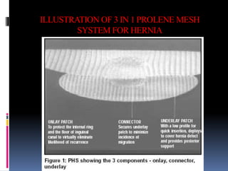 HERNIA TECHNIQUE COMPARISION-REVIEW OF TENSION FREE REPAIRS | PPT