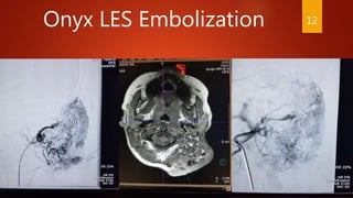 Neurovascular Devices and Clinical ApplicationsNEW [Autosaved] | PPTX