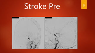 Neurovascular Devices and Clinical ApplicationsNEW [Autosaved] | PPTX