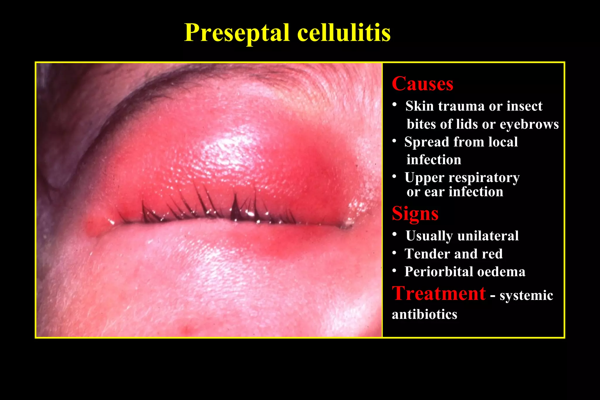 03 diffuse eyelid diseases | PPT