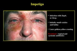 03 diffuse eyelid diseases | PPT
