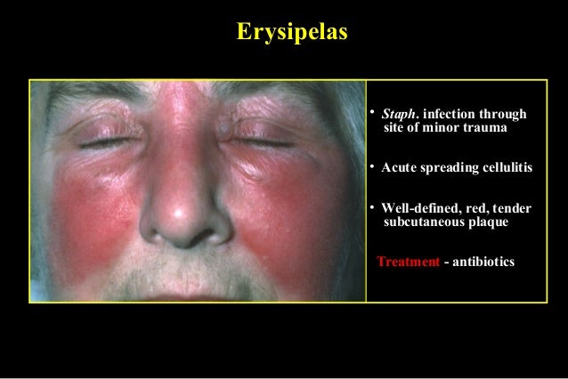 Minor Cellulitis