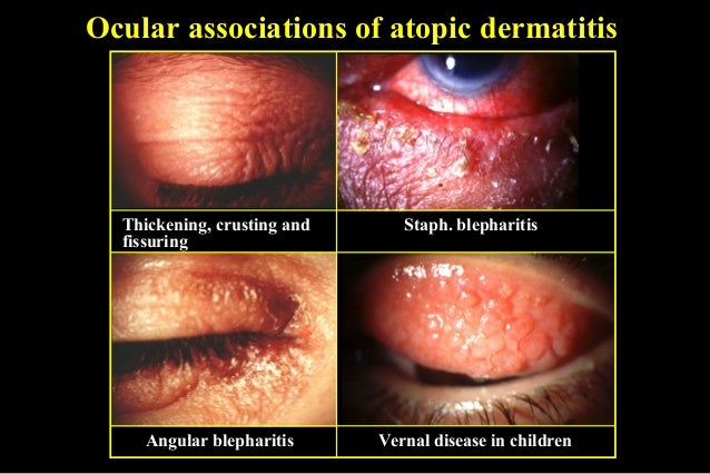 03 diffuse eyelid diseases