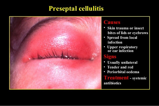 03 diffuse eyelid diseases