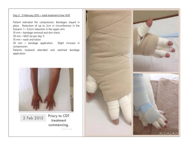 Pilot Case Study in Mauritius for the Treatment of Lymphedema using ...