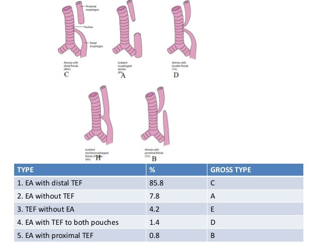 Tracheoesophageal Fistula Classification