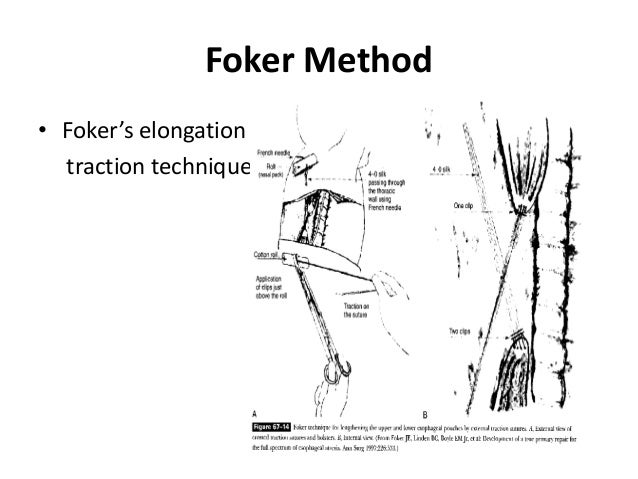 Eosophageal Atresia - Tracheo-esophageal Fistula
