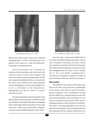 Mineral Trioxide Aggregate (MTA) in apexification | PDF