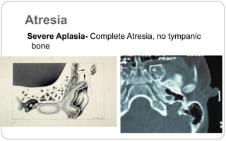 External auditory canal anatomy pathologies & management | PPTX