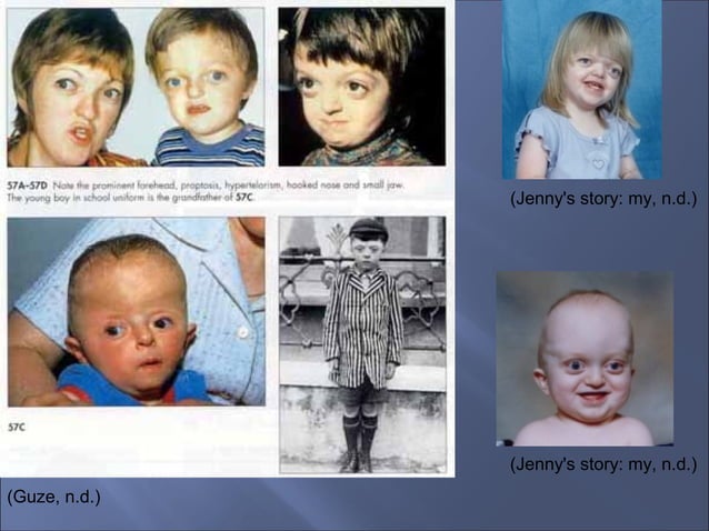 Crouzon’s Syndrome | PPT | Ear, Nose and Throat Conditions | Diseases ...