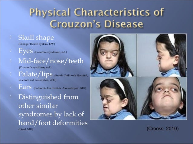 Crouzon’s Syndrome