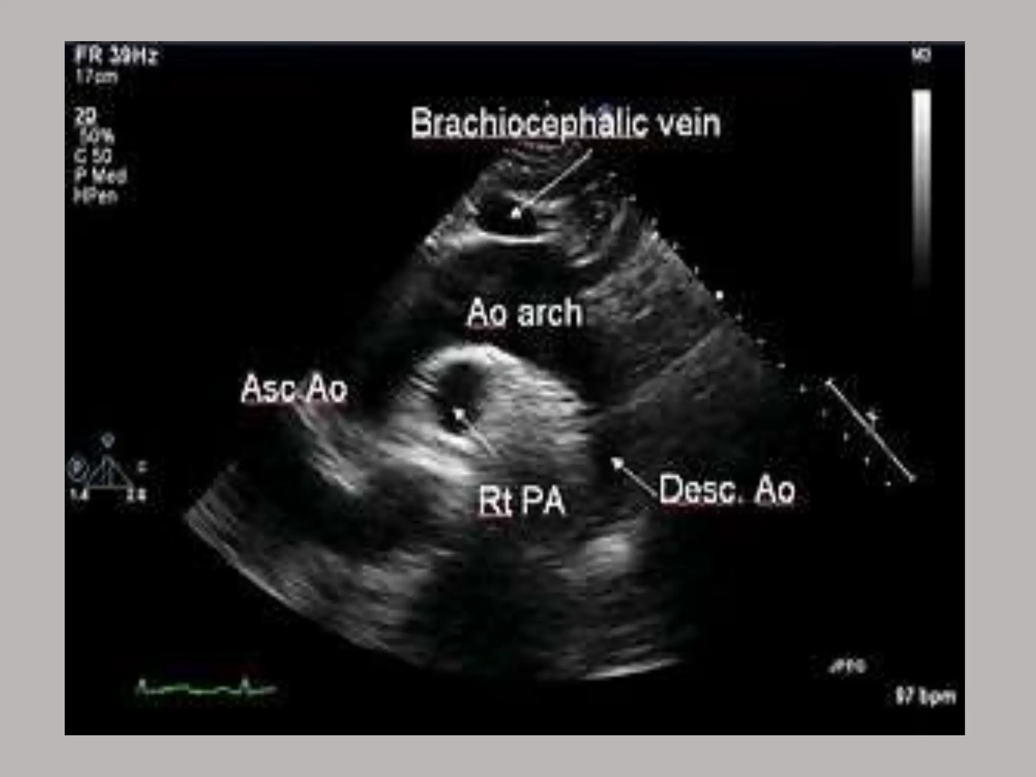 how to read echocardiography of heart.pptx
