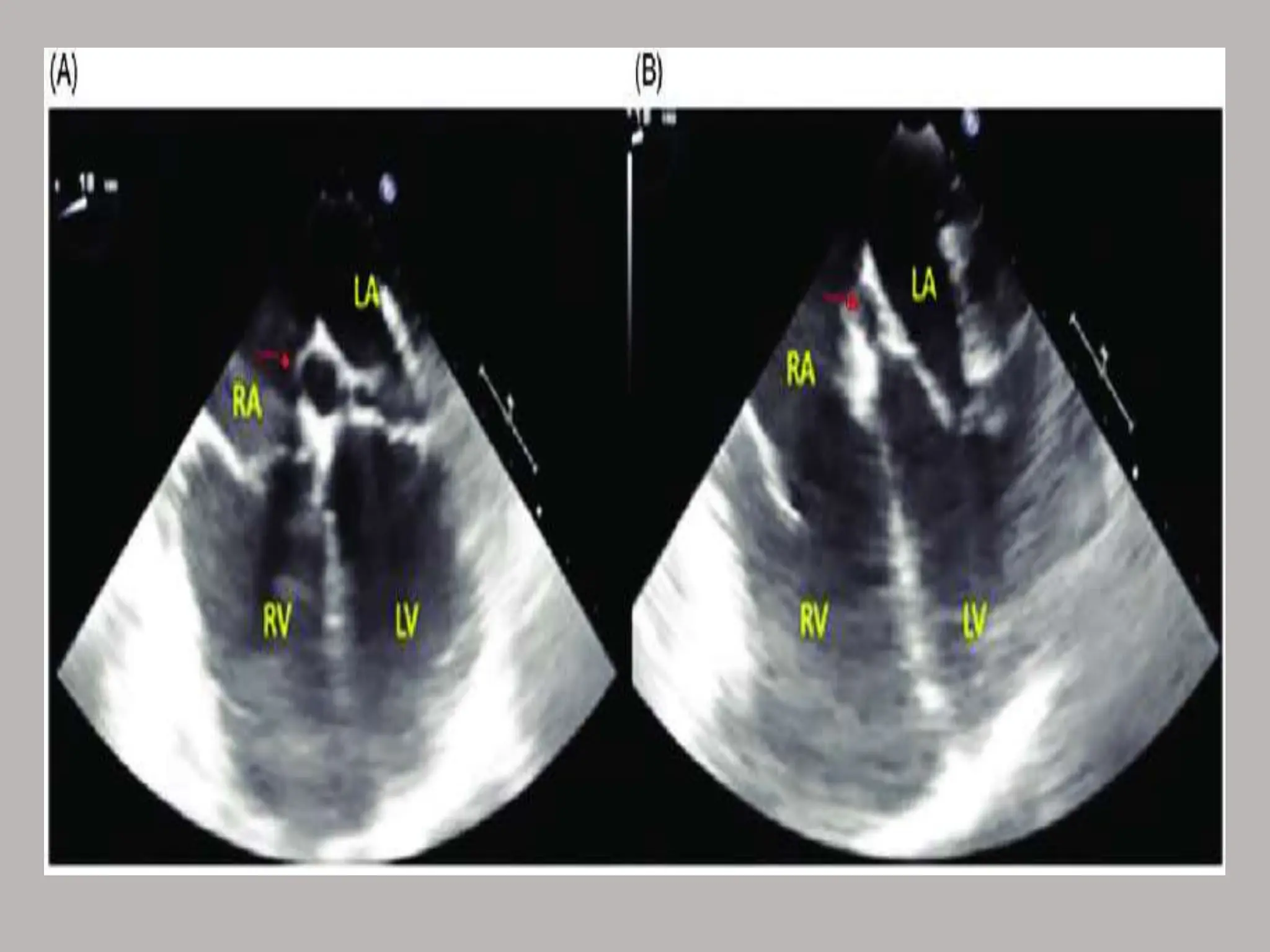 how to read echocardiography of heart.pptx