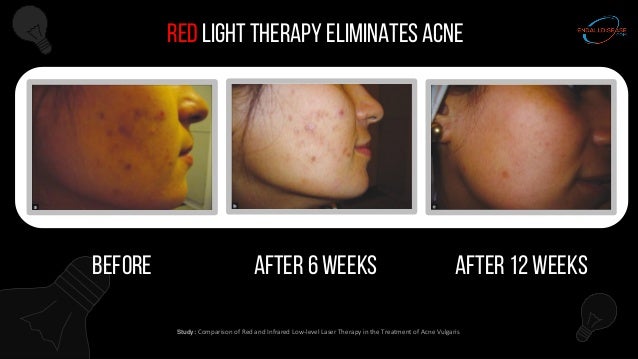 Rejuvenate Your Skin With Red Light Therapy - Before and After Pictur…