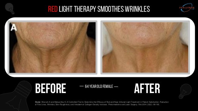 Rejuvenate Your Skin With Red Light Therapy - Before and After Pictur…