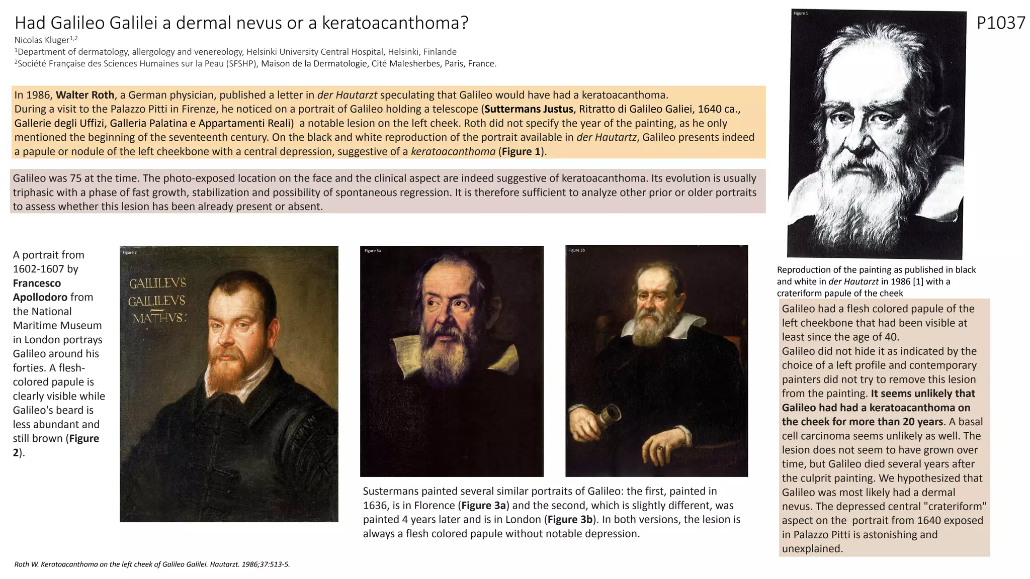 Had Galileo a keratoacanthoma? EADV 2019, Poster 1037 | PPTX