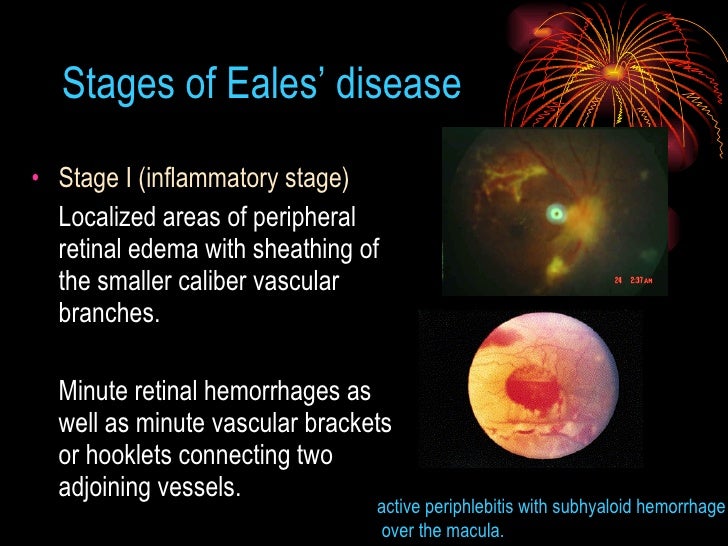 Eales’ Disease