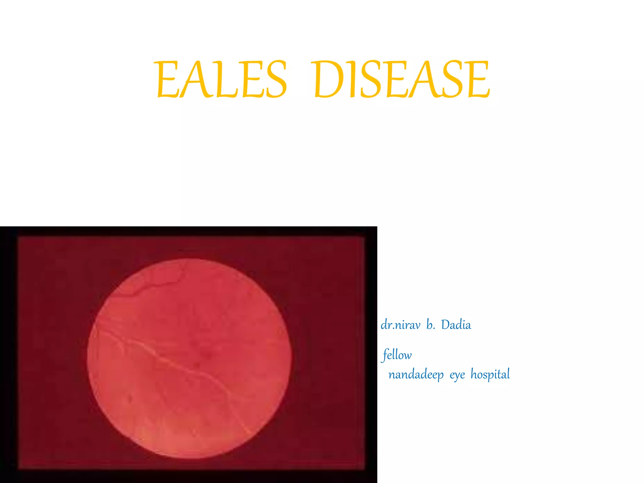 Eales disease | PPTX