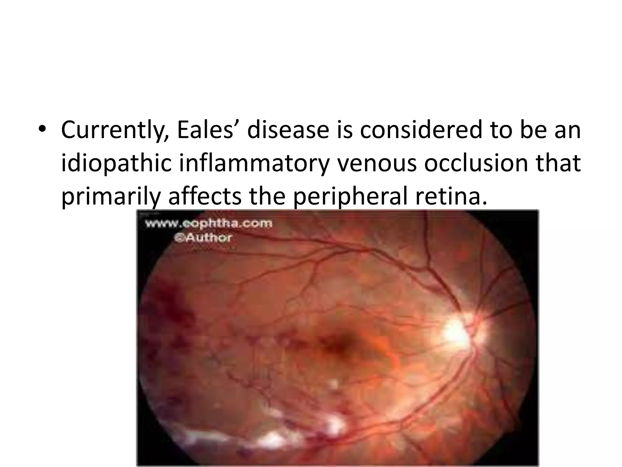 Eales disease | PPTX