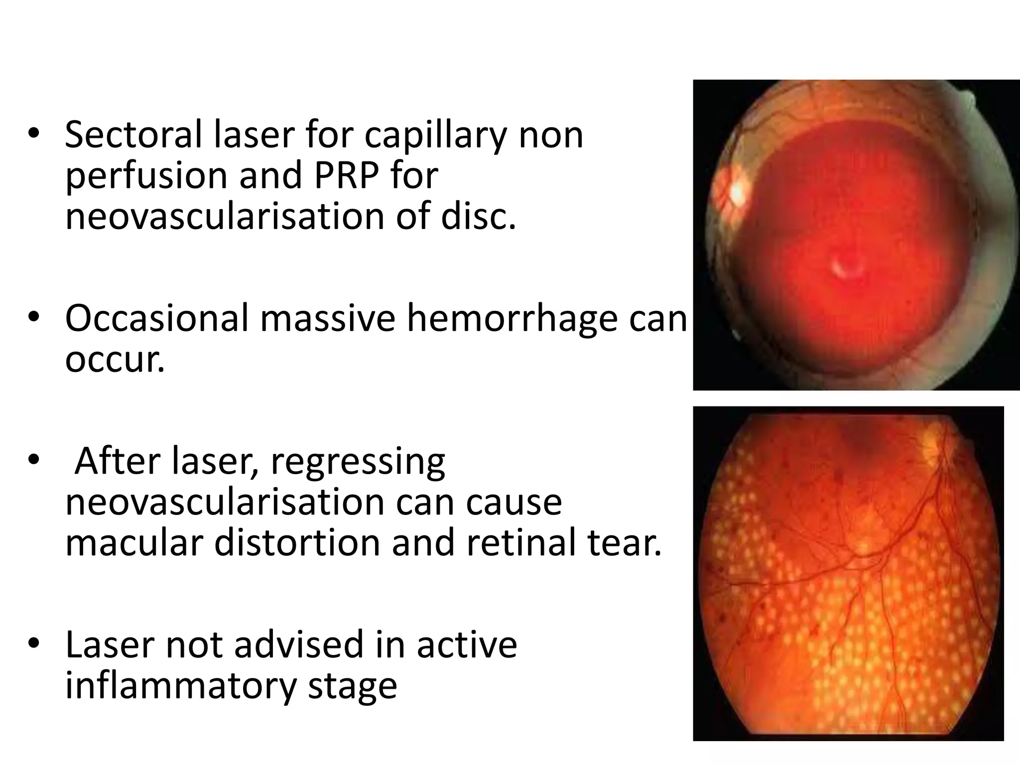 Eales disease | PPTX