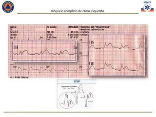 Enfarte Agudo do Miocárdio com Supra ST - Guidelines ESC 2017 | PDF