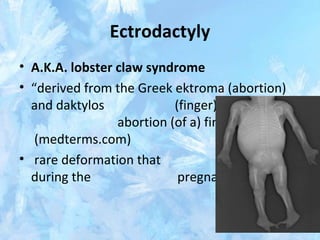 Student Work Ectrodactyly | PPT