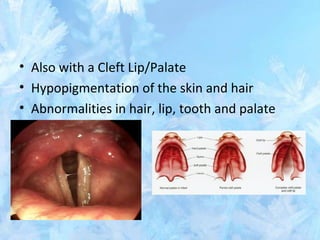 Student Work Ectrodactyly | PPT