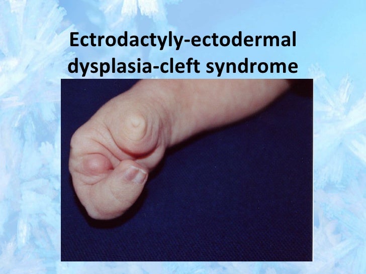 Student Work Ectrodactyly