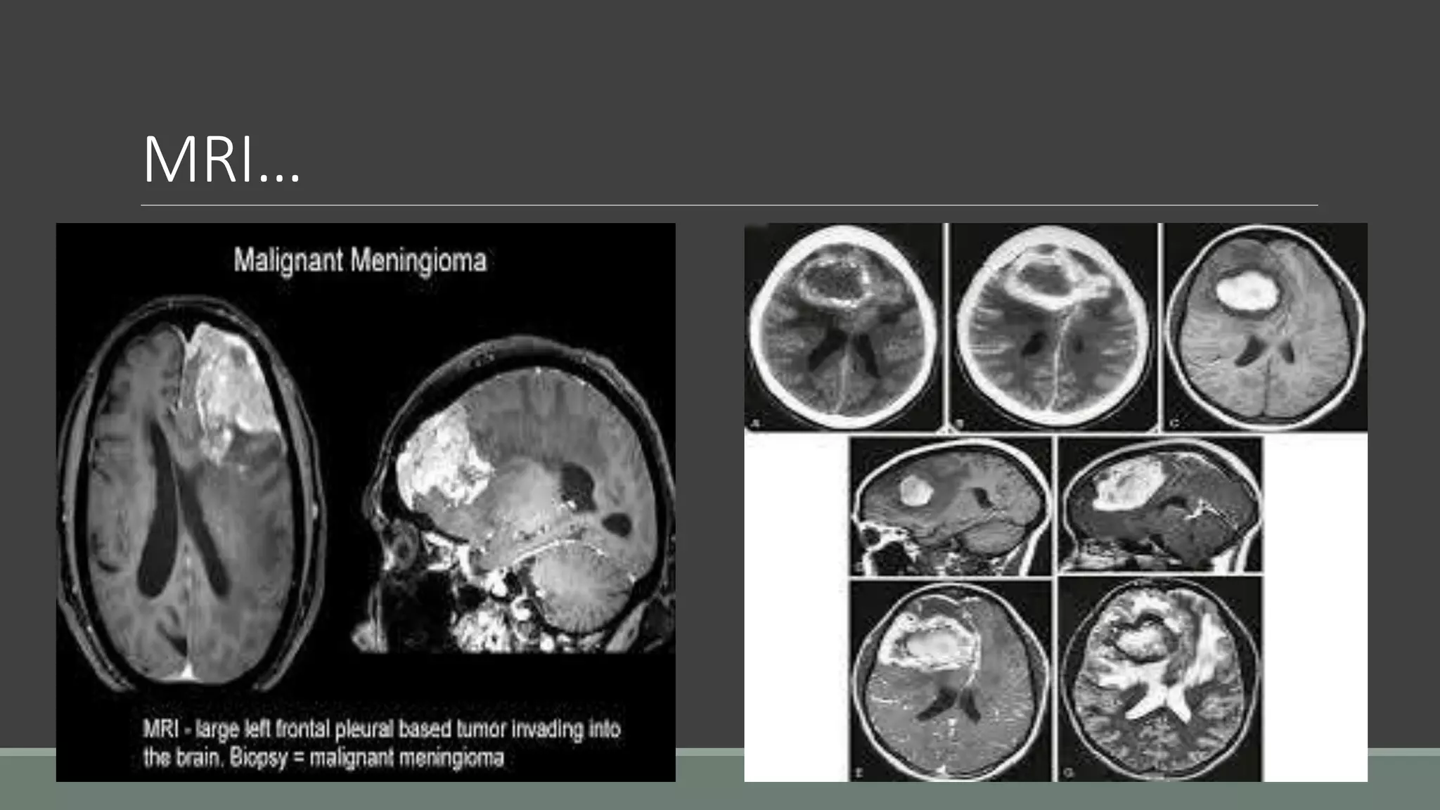 EANO GUIDELINES FOR MANAGEMENT OF MENINGIOMA | PPTX