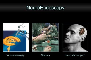 The role of neuro endoscopy | PPT | Brain and Nervous System Disorders ...