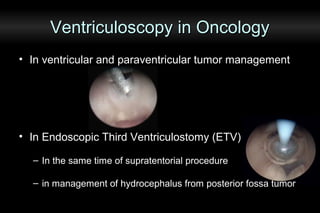The role of neuro endoscopy | PPT