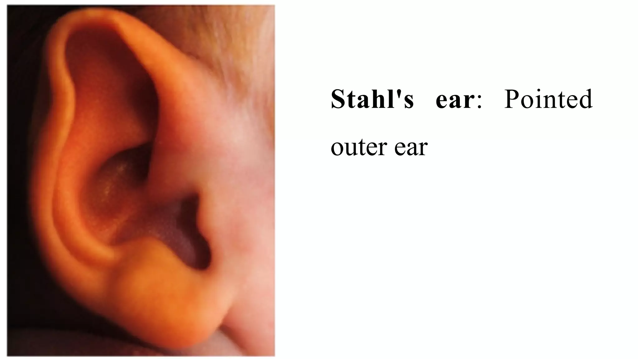 EAR ASSESSMENT | PDF