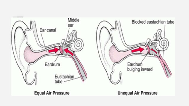 Ear barotrauma causes, symptoms and treatment | PPT