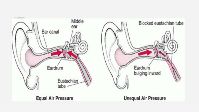 Ear barotrauma causes, symptoms and treatment
