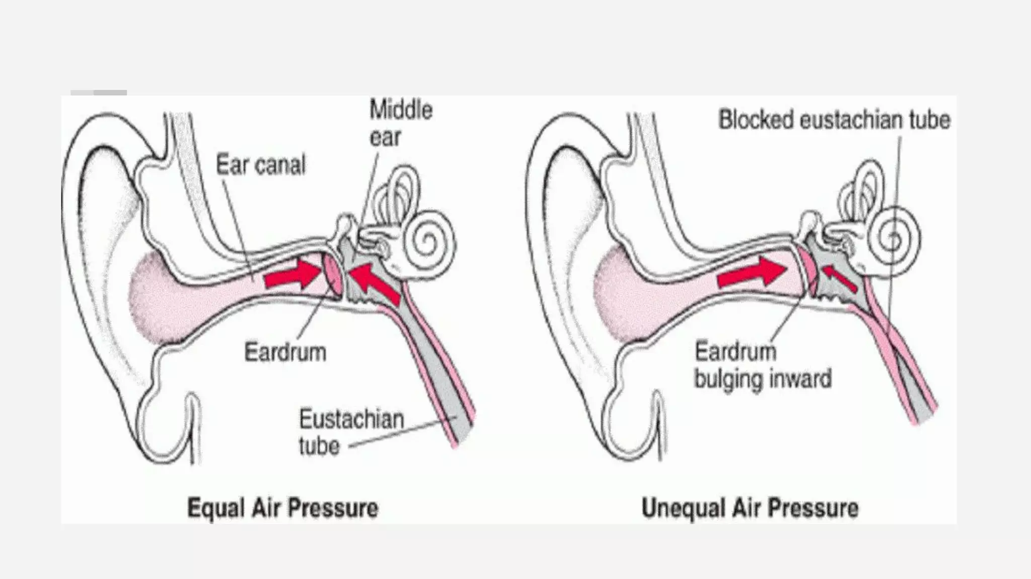 Ear barotrauma causes, symptoms and treatment | PDF