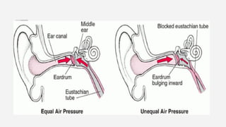 Ear barotrauma causes, symptoms and treatment | PDF